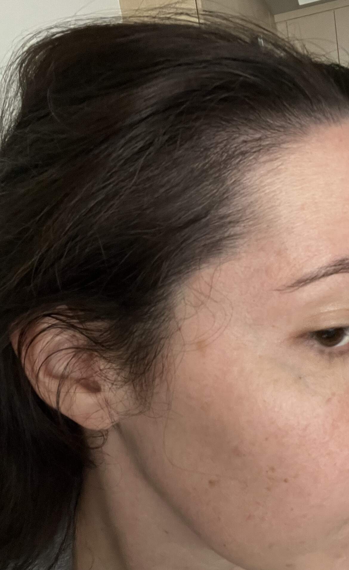 My experience: scalp micropigmentation For Hair Loss - Master Your Hair
